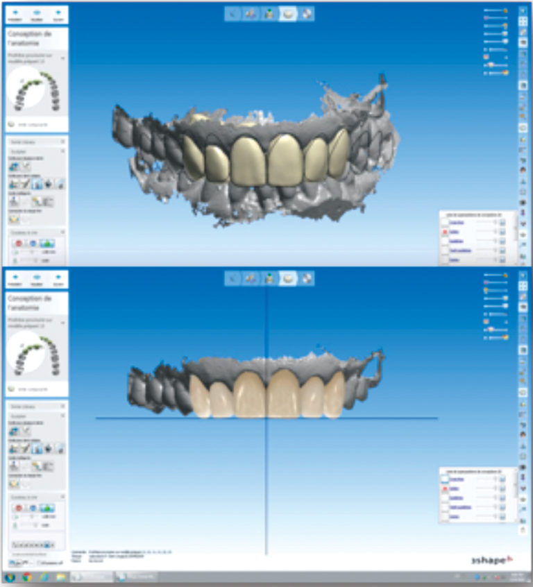 3D Digital Smile Treatment Plan: What are the Advantages?