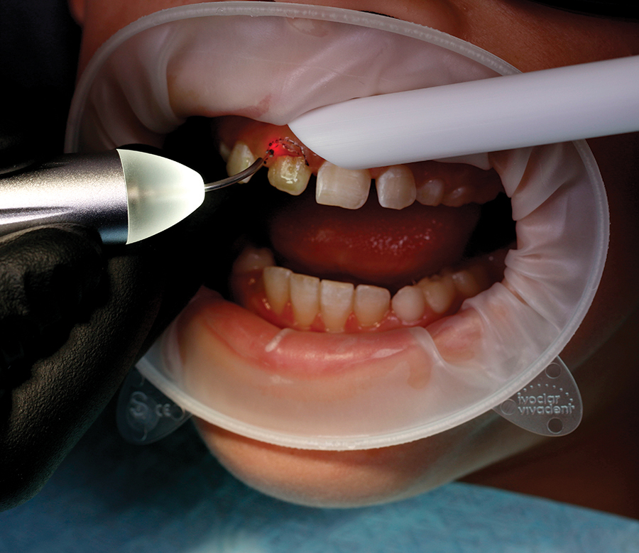 Esthetics and the Mixed Dentition - A Responsible Solution