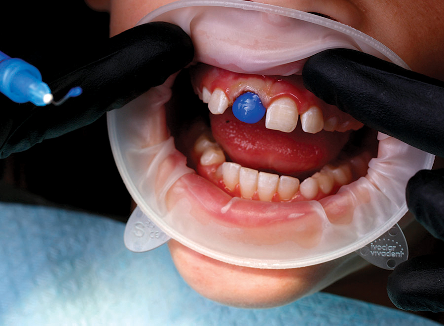 Esthetics and the Mixed Dentition - A Responsible Solution