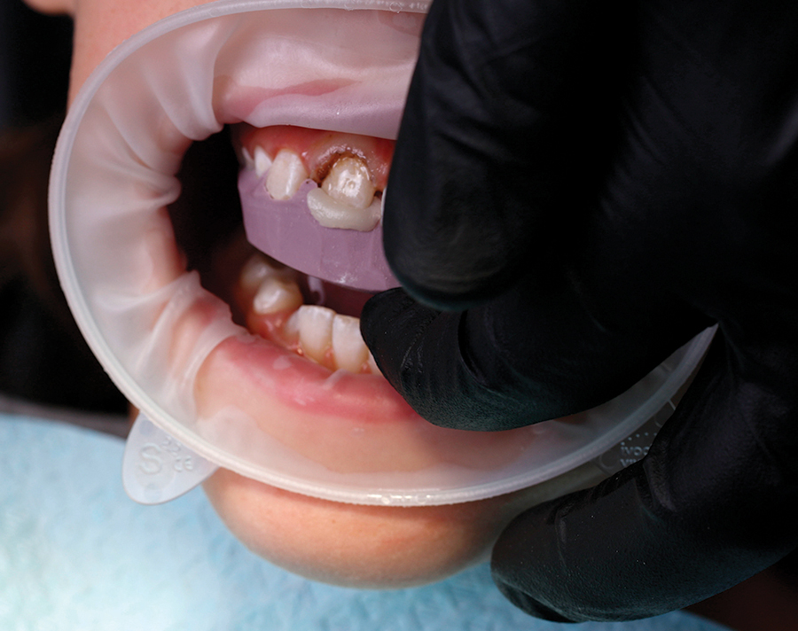 Esthetics and the Mixed Dentition - A Responsible Solution