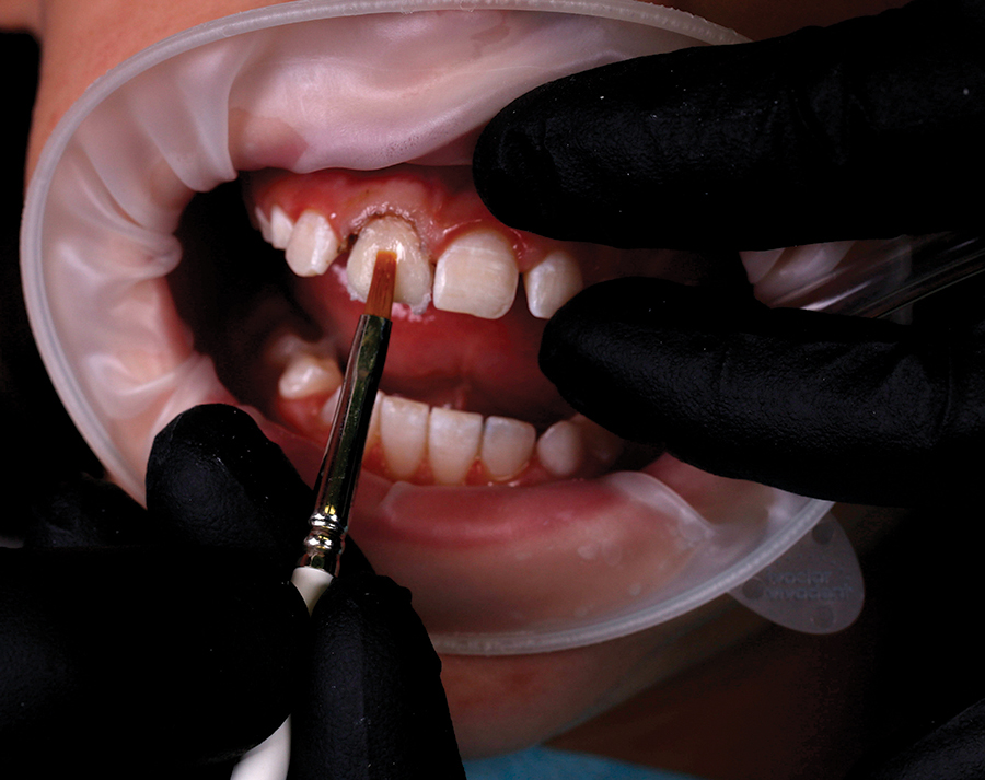 Esthetics and the Mixed Dentition - A Responsible Solution