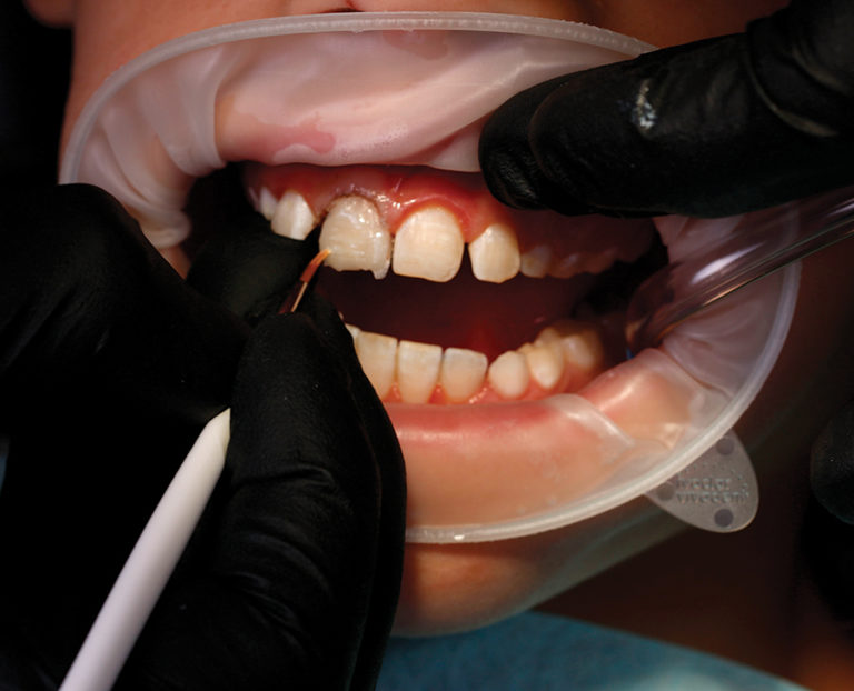 Esthetics and the Mixed Dentition - A Responsible Solution