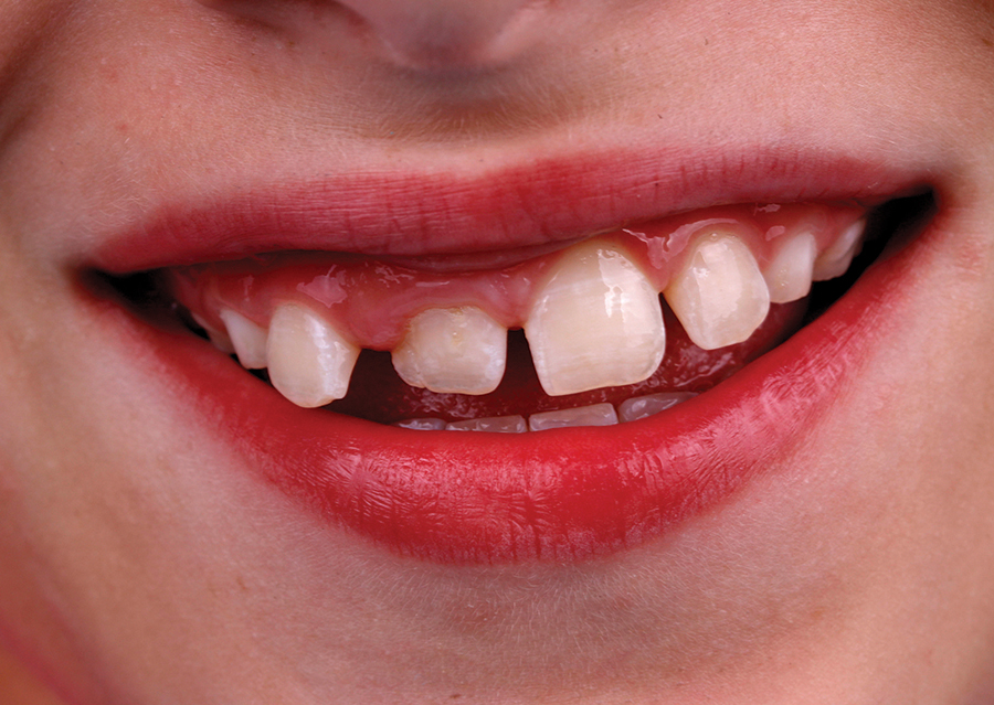 Esthetics and the Mixed Dentition - A Responsible Solution