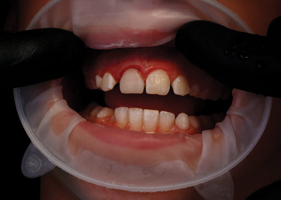 Esthetics and the Mixed Dentition - A Responsible Solution