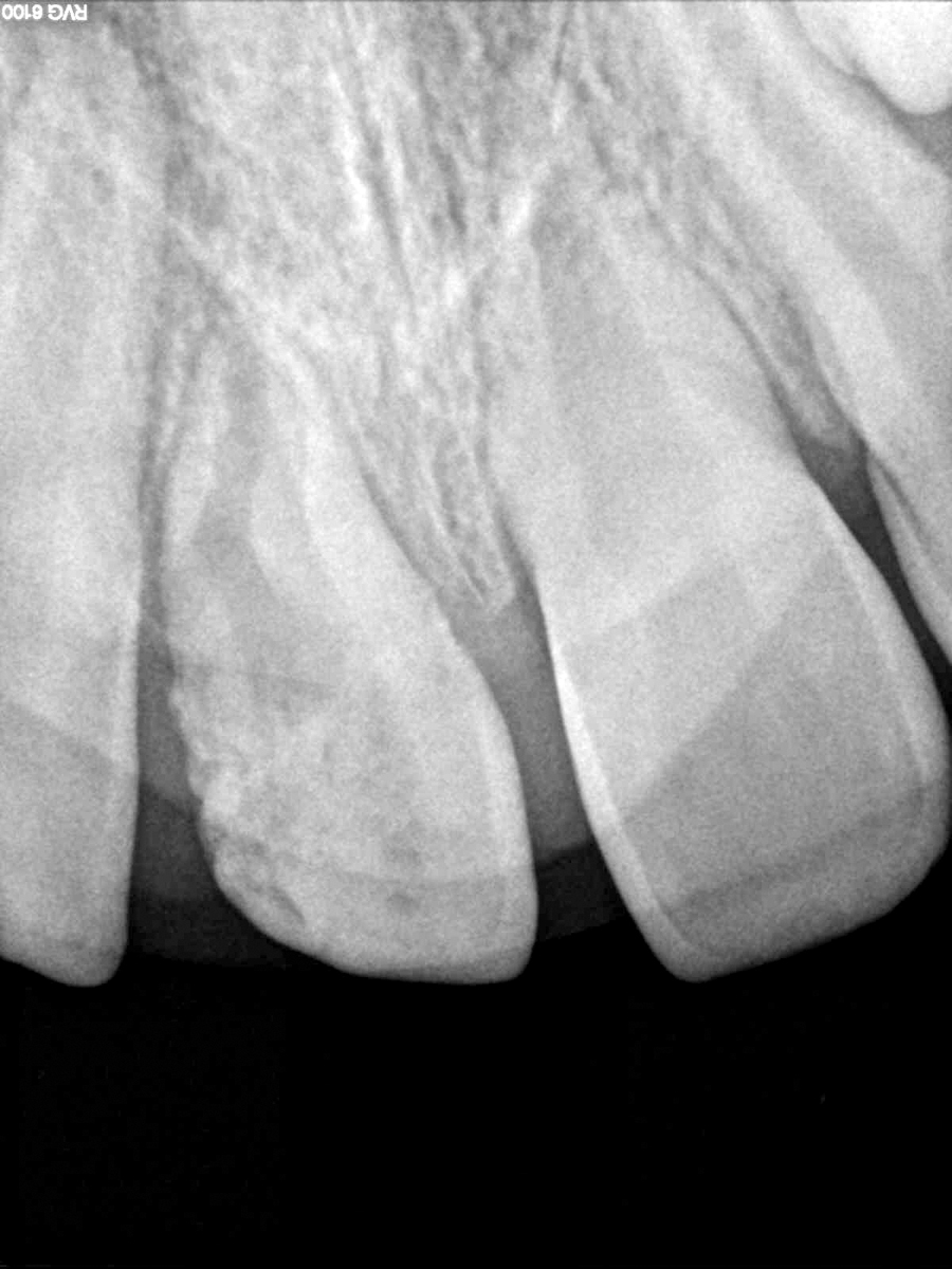 Esthetics and the Mixed Dentition - A Responsible Solution