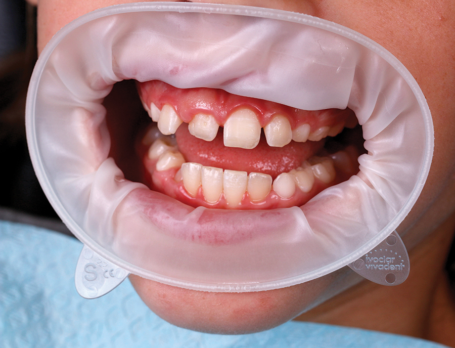 Esthetics and the Mixed Dentition - A Responsible Solution