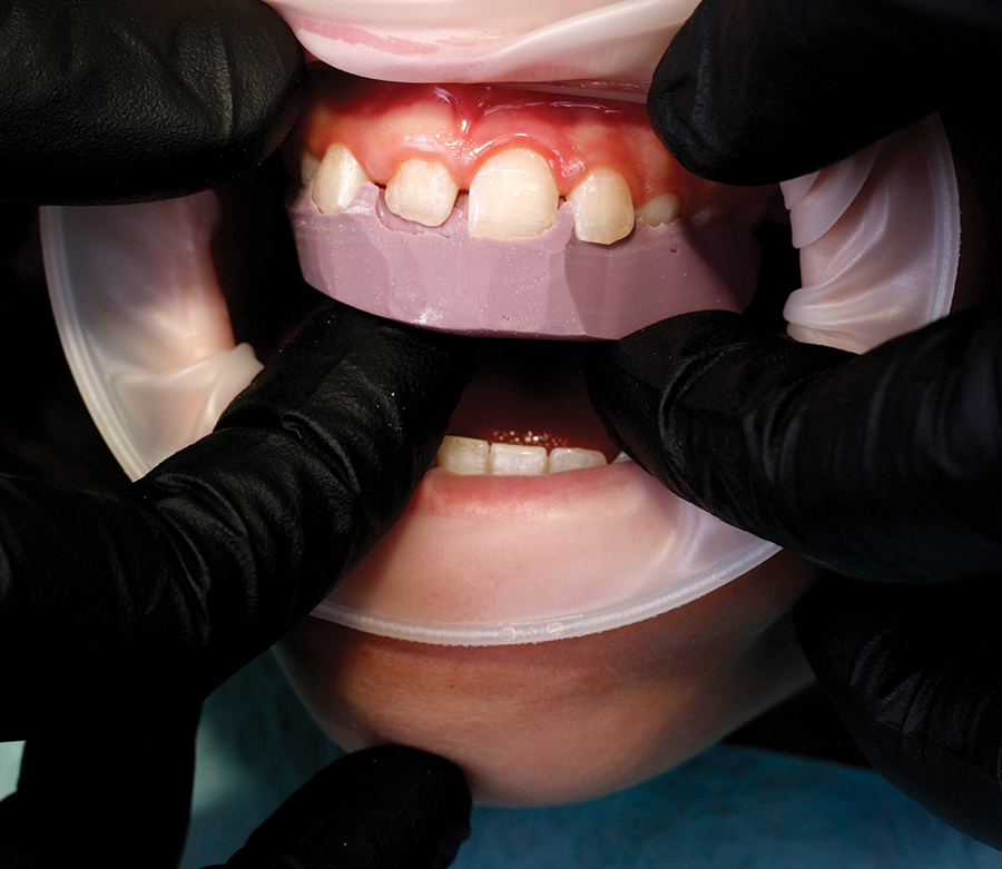 Esthetics and the Mixed Dentition - A Responsible Solution
