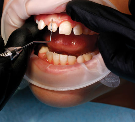 Esthetics and the Mixed Dentition - A Responsible Solution