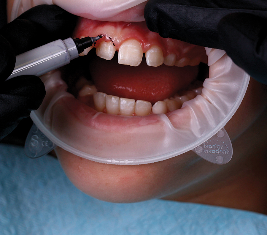 Esthetics and the Mixed Dentition - A Responsible Solution