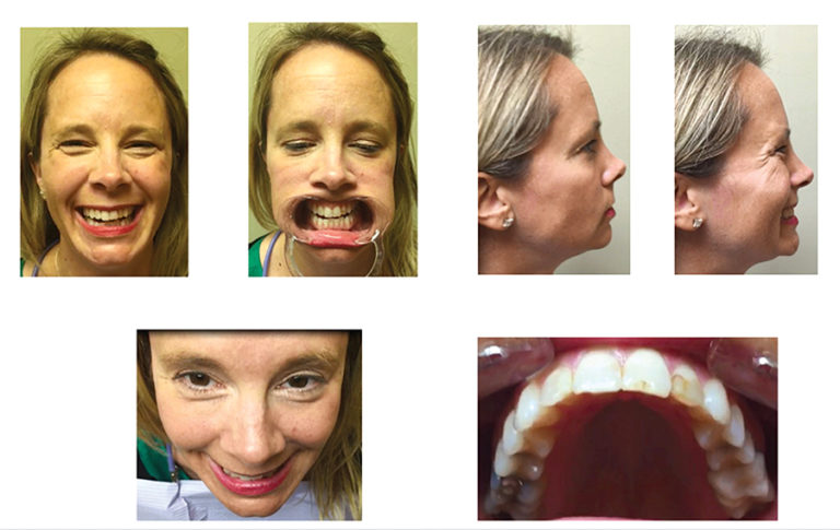 The Use of Digital Smile Design for Everyday Dentistry - Oral Health Group