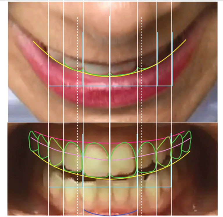 The Use of Digital Smile Design for Everyday Dentistry - Oral Health Group