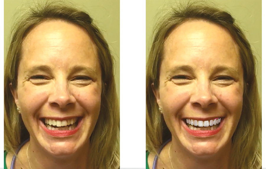 The Use of Digital Smile Design for Everyday Dentistry - Oral Health Group