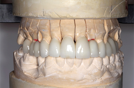 Treatment of Tetracycline Discoloured Teeth with Full Ceramic Restorations