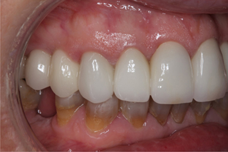 Treatment of Tetracycline Discoloured Teeth with Full Ceramic Restorations