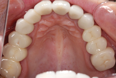 Treatment of Tetracycline Discoloured Teeth with Full Ceramic Restorations