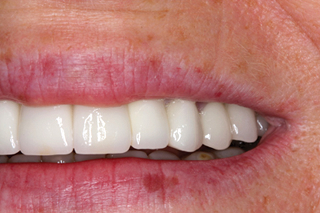 Treatment of Tetracycline Discoloured Teeth with Full Ceramic Restorations