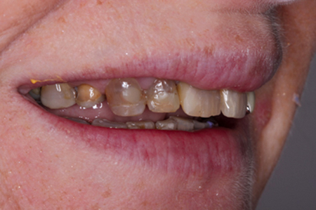 Treatment of Tetracycline Discoloured Teeth with Full Ceramic Restorations