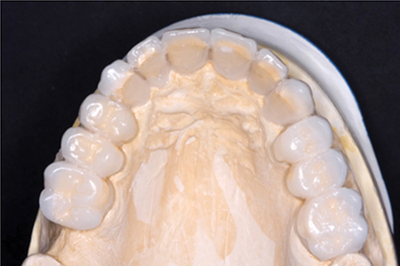 Treatment of Tetracycline Discoloured Teeth with Full Ceramic Restorations