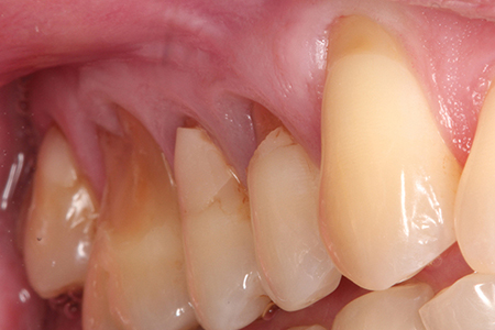 Ward Fig 19 Pre-Operative View Abfraction lesions - Oral Health Group
