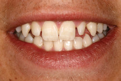Creating Natural-Looking Composite Restorations Using Different ...