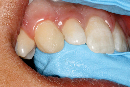 Ward Fig 7 Addition of Enamel layer - Oral Health Group