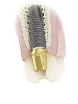Dentsply Sirona Implant Supporting Full Implant Treatment Process ...