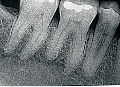 Successful Endodontic Treatment of Internal Cervical Root Resorption