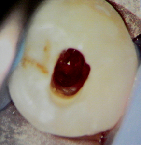 Successful Endodontic Treatment of Internal Cervical Root Resorption