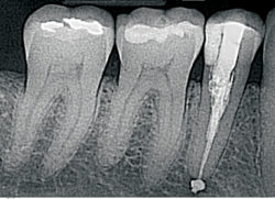 Successful Endodontic Treatment of Internal Cervical Root Resorption