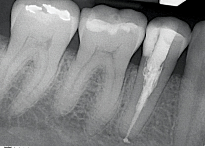 Successful Endodontic Treatment of Internal Cervical Root Resorption