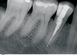Successful Endodontic Treatment of Internal Cervical Root Resorption