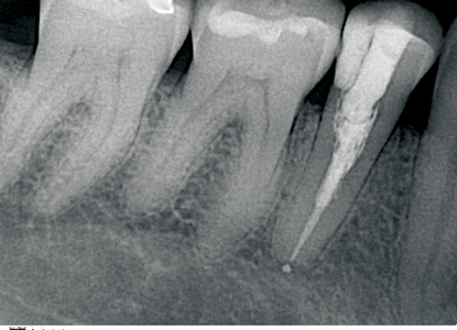 Successful Endodontic Treatment of Internal Cervical Root Resorption