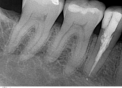 Successful Endodontic Treatment of Internal Cervical Root Resorption