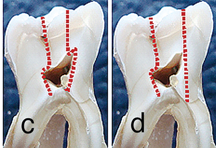 Bio-Minimalism: Trends and Transitions in Endodontics - Oral Health Group