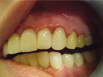 Improving Predictability of Final Outcomes in Full Mouth Reconstruction