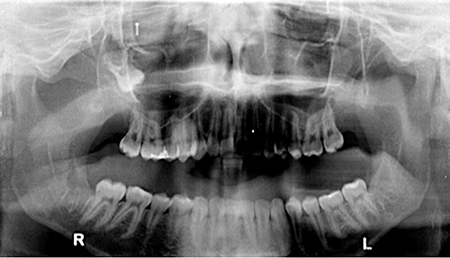 Teeth Displaced: Teeth at the Time of Surgery - Oral Health Group