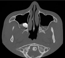 Teeth Displaced: Teeth at the Time of Surgery - Oral Health Group