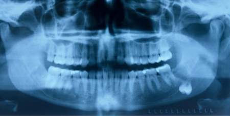 Teeth Displaced: Teeth at the Time of Surgery - Oral Health Group