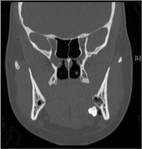Teeth Displaced: Teeth at the Time of Surgery - Oral Health Group