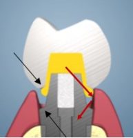 Controlling Excess Cement During the Process of Intra-Oral Prosthesis ...