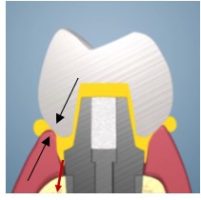 Controlling Excess Cement During the Process of Intra-Oral Prosthesis ...