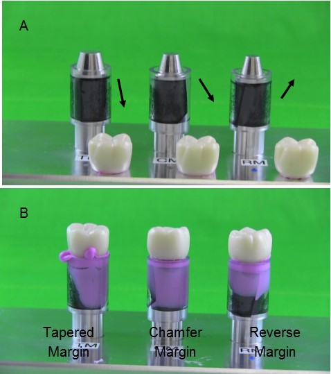 Controlling Excess Cement During the Process of Intra-Oral Prosthesis ...