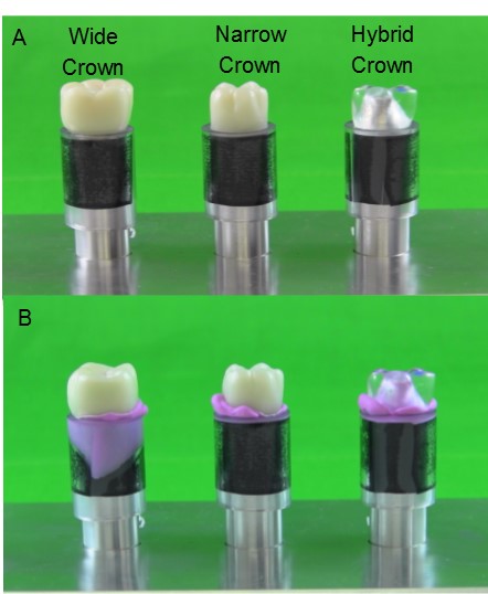 Controlling Excess Cement During the Process of Intra-Oral Prosthesis ...