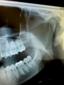 Surgical Misadventures: The Broken Needle - Oral Health Group