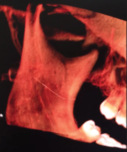 Surgical Misadventures: The Broken Needle - Oral Health Group