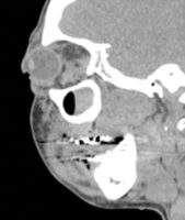 A Rare Complication of a Retrobulbar Hematoma Formation
