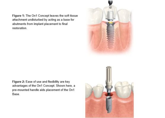 On1™: A New Concept in Tissue-Level Treatment - Oral Health Group