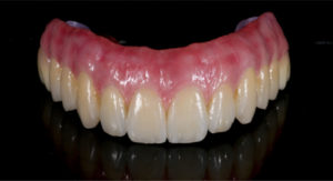 Full Arch Immediate Fixed Implant Rehabilitation: A Case Demonstration