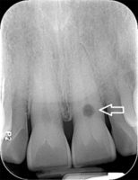CBCT In Treatment Planning Of External Cervical Resorption: A Case Series