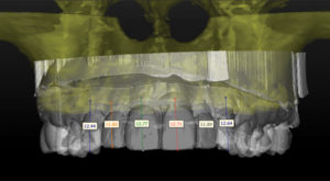 Predicting The Transition Line Of An Immediate Complete Maxillary ...